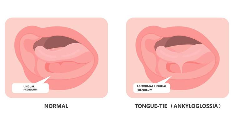 London Tongue And Lip Tie Centre Tabbara Dentistry